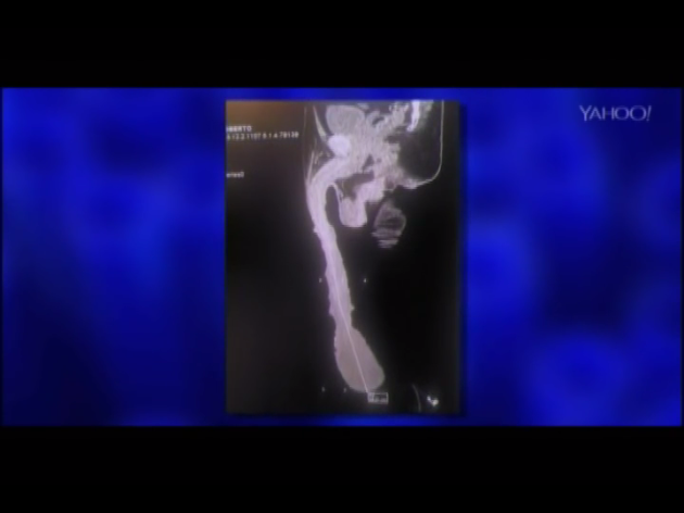 Man claims his 19-inch penis making his life hard | Inquirer News