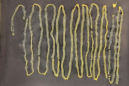 2.8m-long tapeworm found in patient who had no symptoms | Inquirer News