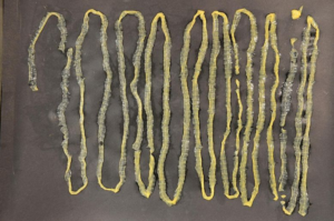 2.8m-long tapeworm found in patient who had no symptoms | Inquirer News