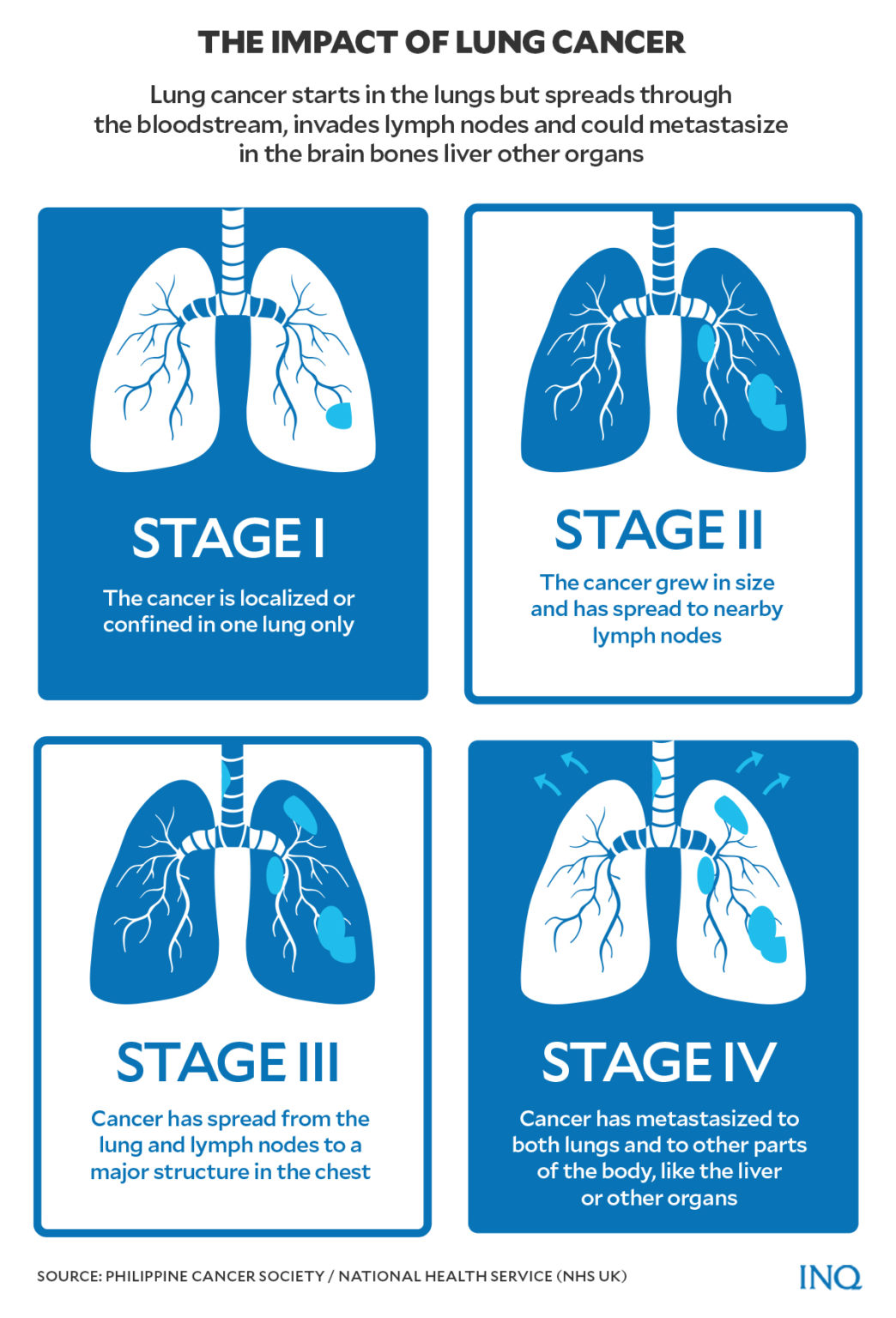 Lung cancer: The deadliest type of cancer in PH | Inquirer News