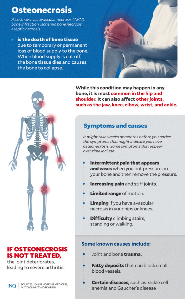 Osteonecrosis or 'bone death': What to know about Angelica Panganiban's ...