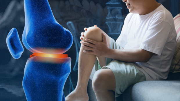 Osteonecrosis or 'bone death': What to know about Angelica Panganiban's ...