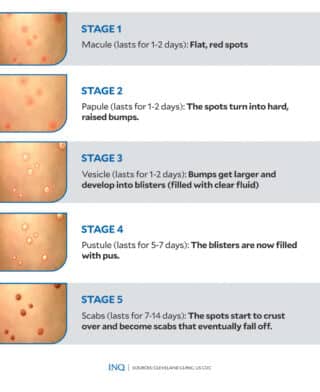 Mpox: What is it, how it spreads, care for patients