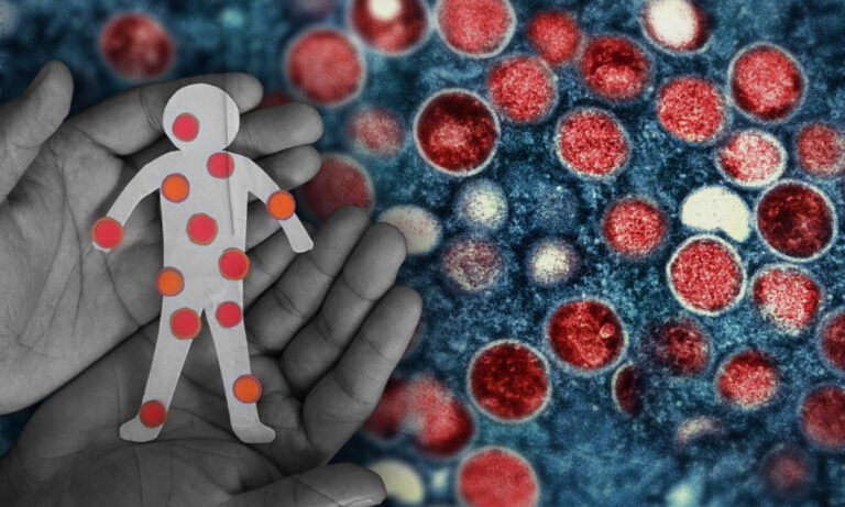 Mpox: What is it, how it spreads, care for patients